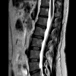 RAIQC: Packages: Package Acute Spinal Pathology